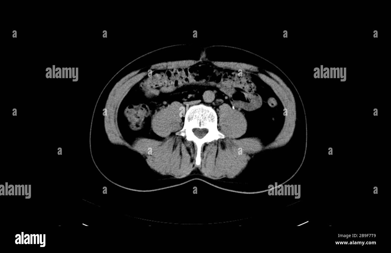Abdomen human, man, CT scan Stock Photo - Alamy