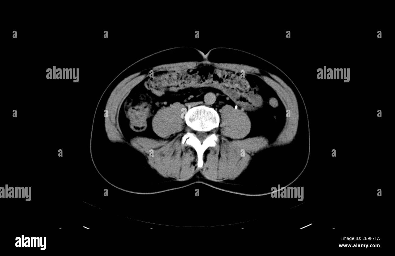 Abdomen human, man, CT scan Stock Photo - Alamy