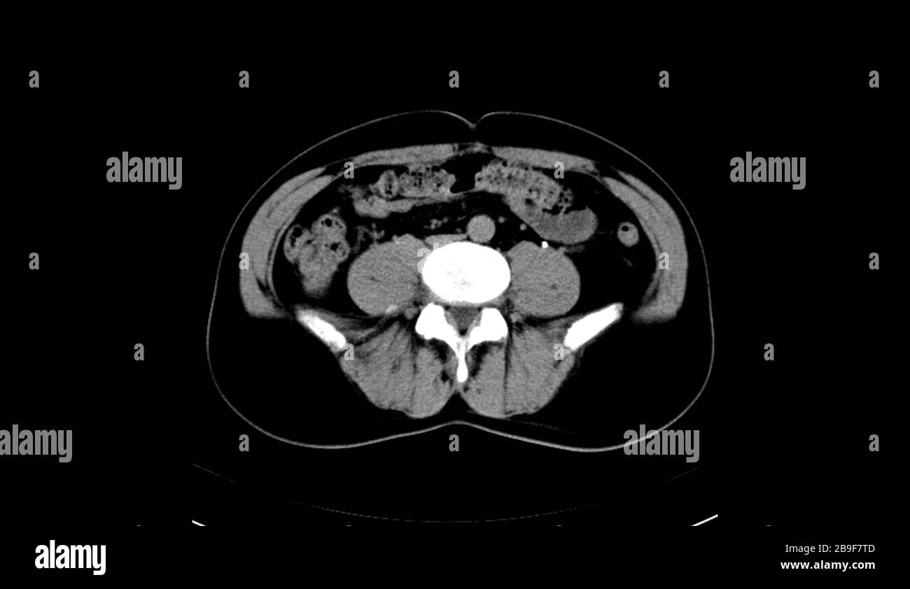 Abdomen human, man, CT scan Stock Photo - Alamy