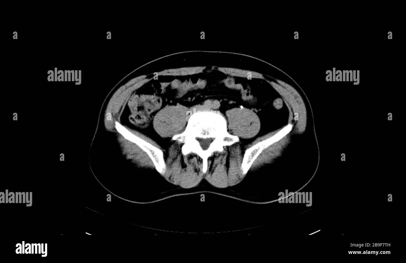 Abdomen human, man, CT scan Stock Photo - Alamy