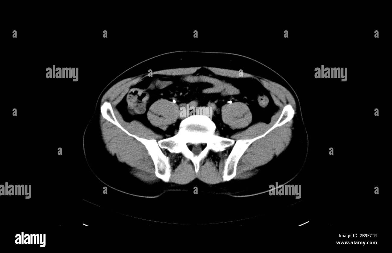 Abdomen human, man, CT scan Stock Photo - Alamy