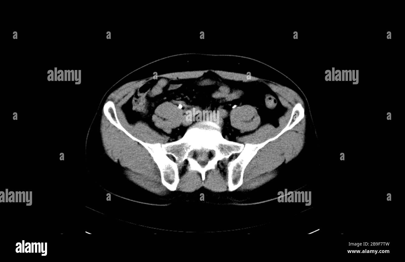 Abdomen human, man, CT scan Stock Photo - Alamy