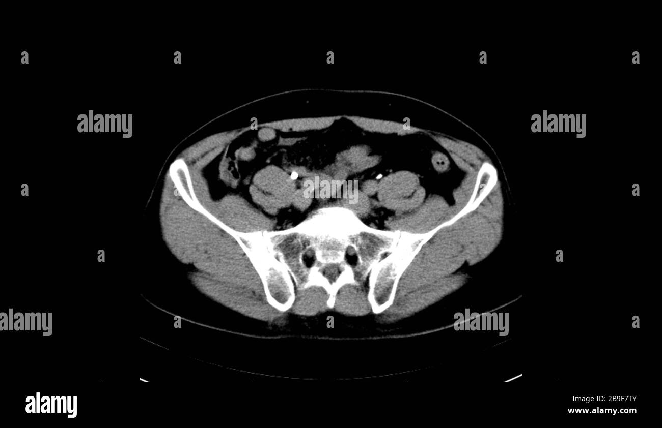 Abdomen human, man, CT scan Stock Photo - Alamy