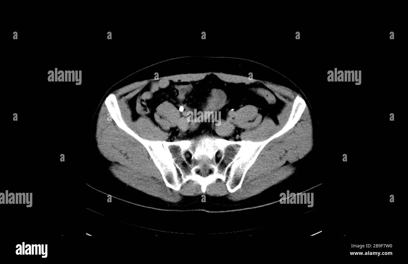 Abdomen human, man, CT scan Stock Photo - Alamy