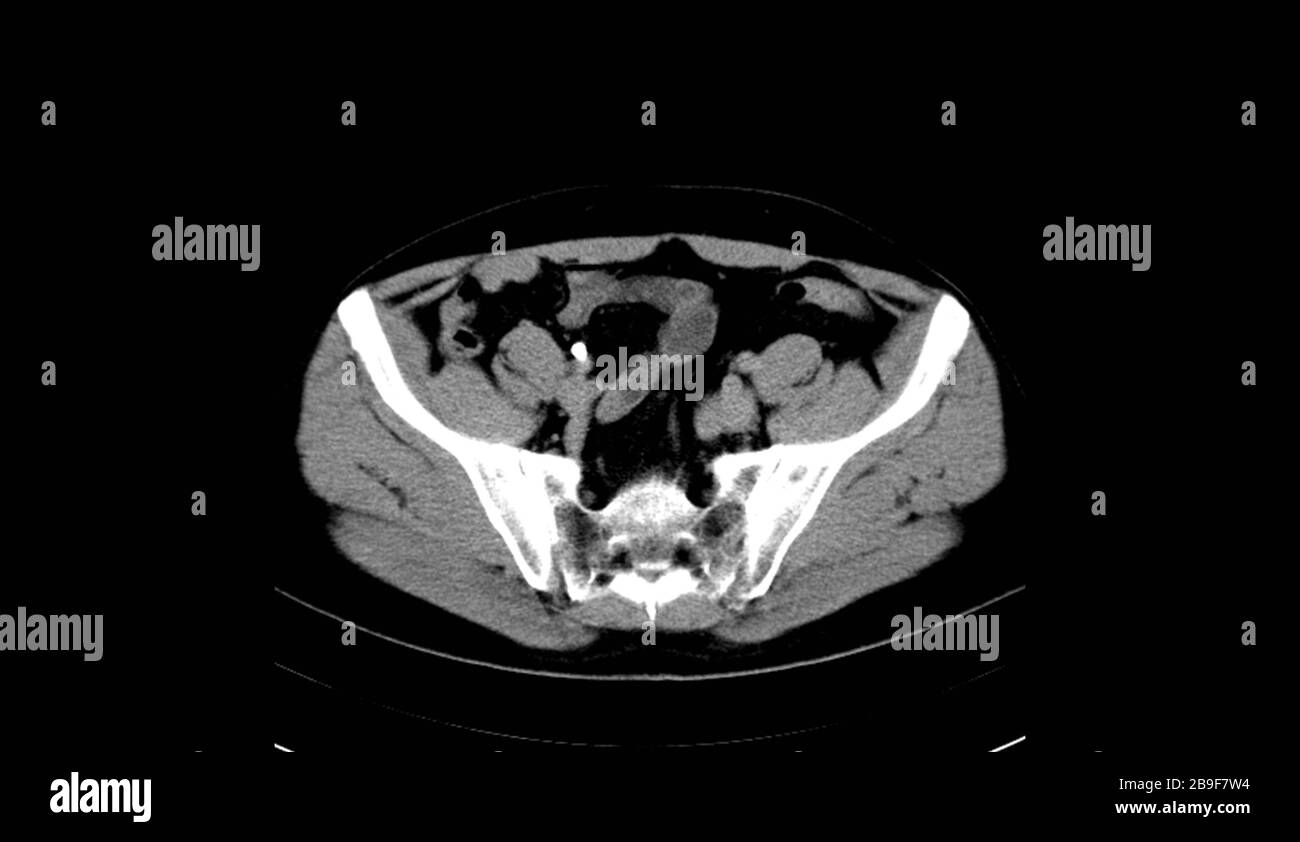 Abdomen human, man, CT scan Stock Photo - Alamy