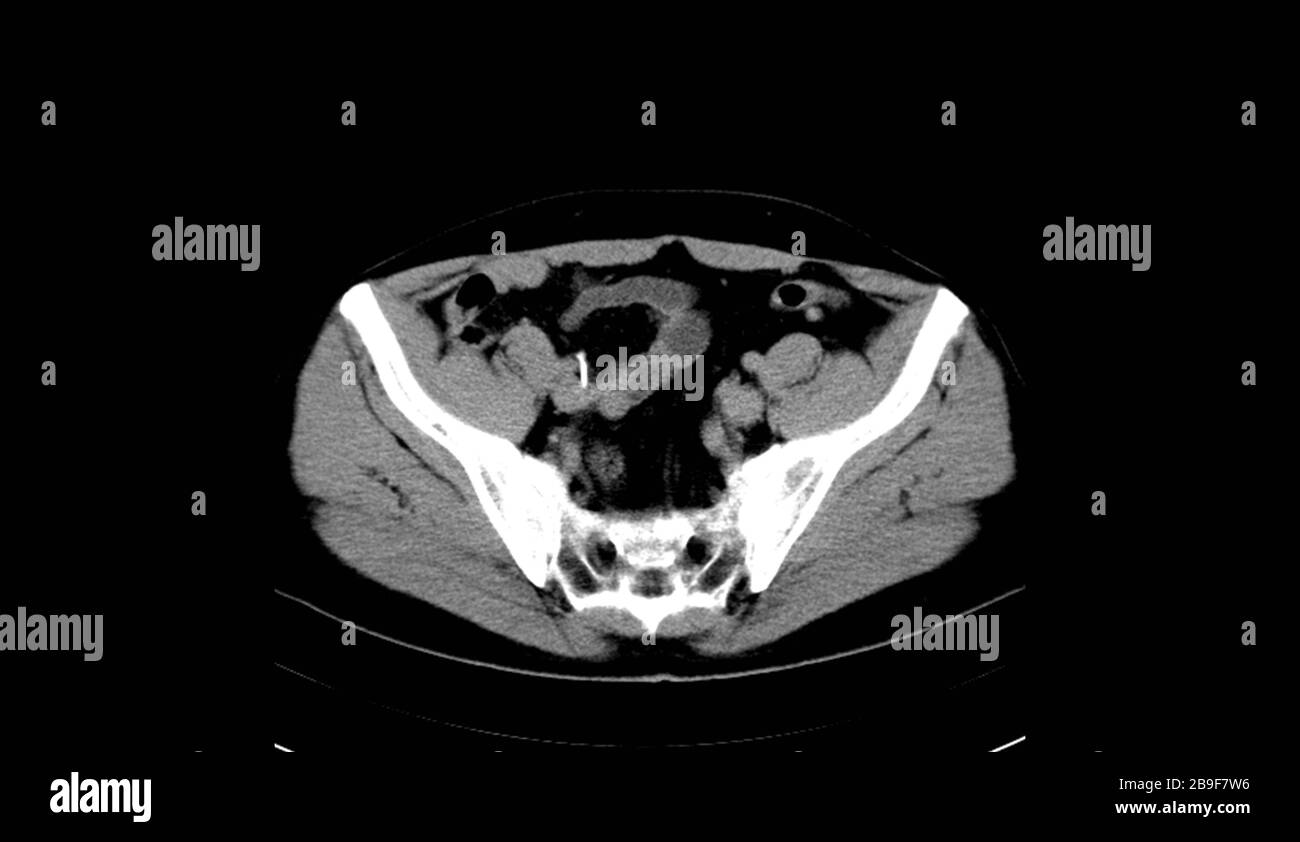 Abdomen human, man, CT scan Stock Photo - Alamy