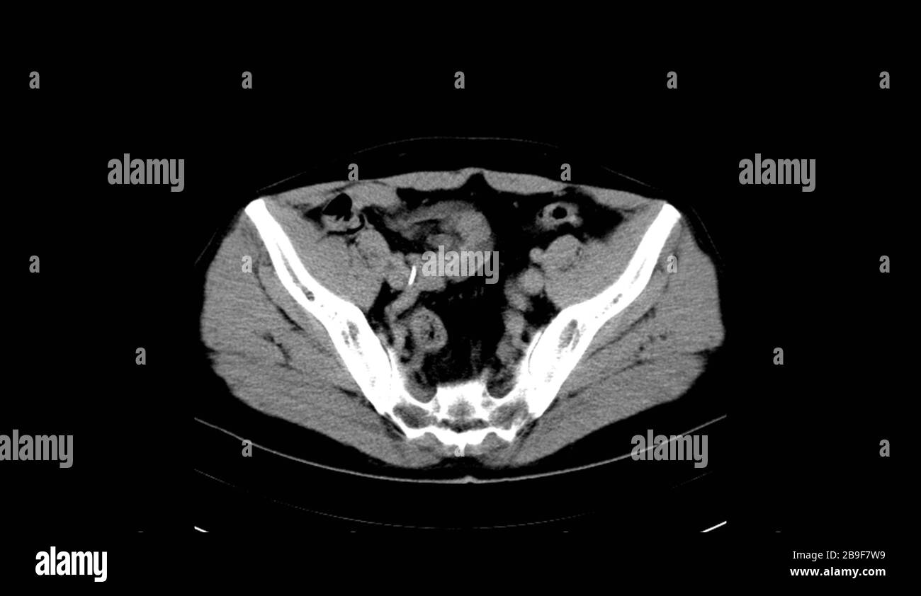 Abdomen human, man, CT scan Stock Photo - Alamy