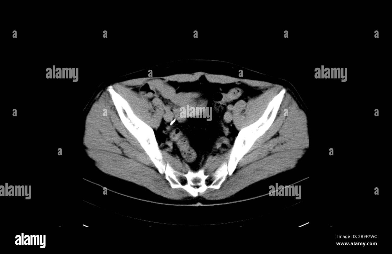 Abdomen human, man, CT scan Stock Photo - Alamy