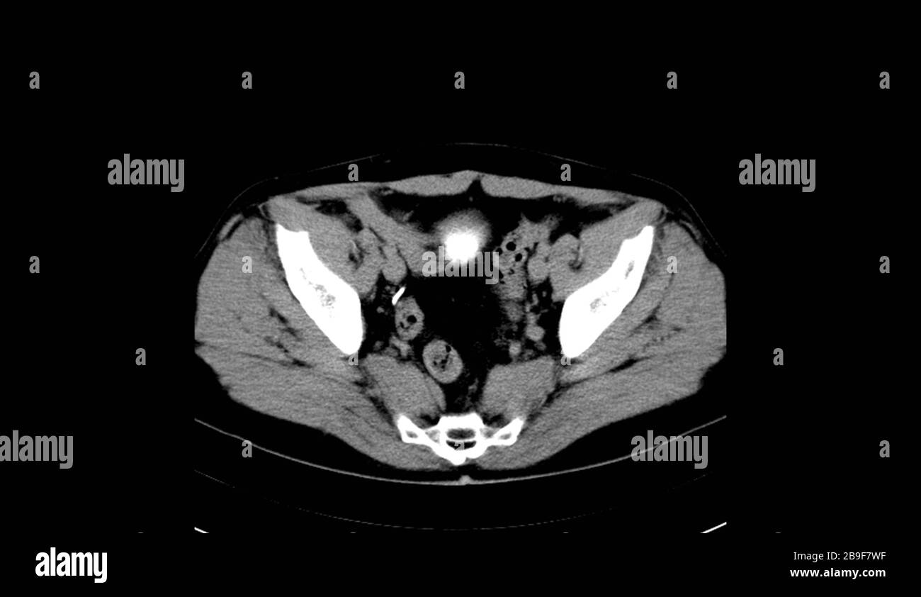 Abdomen human, man, CT scan Stock Photo - Alamy
