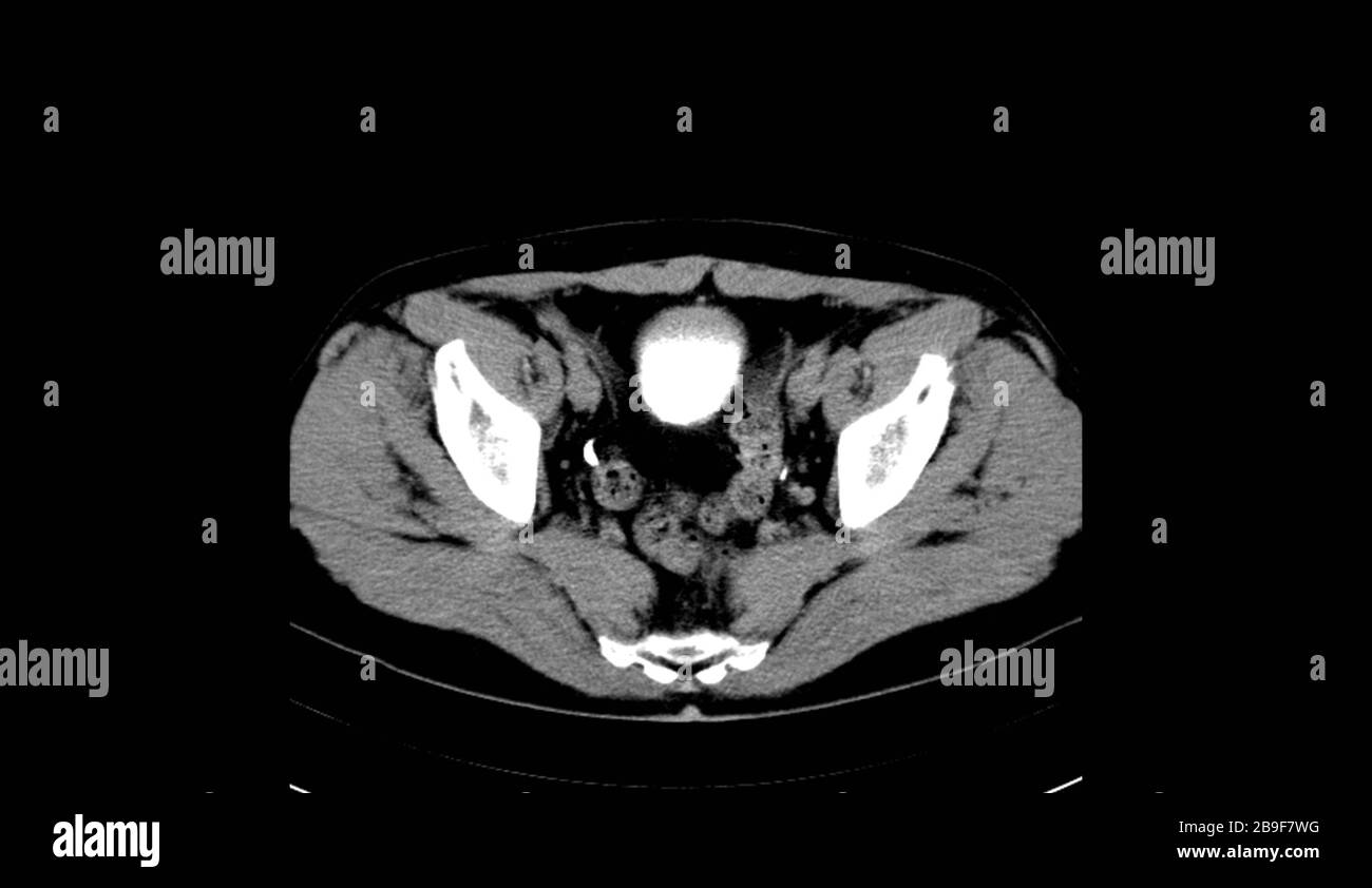Abdomen human, man, CT scan Stock Photo - Alamy