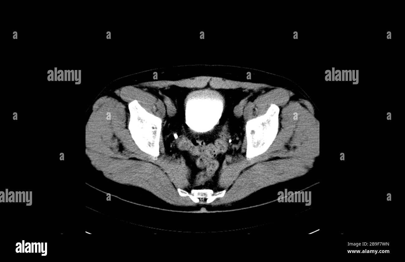 Abdomen human, man, CT scan Stock Photo - Alamy