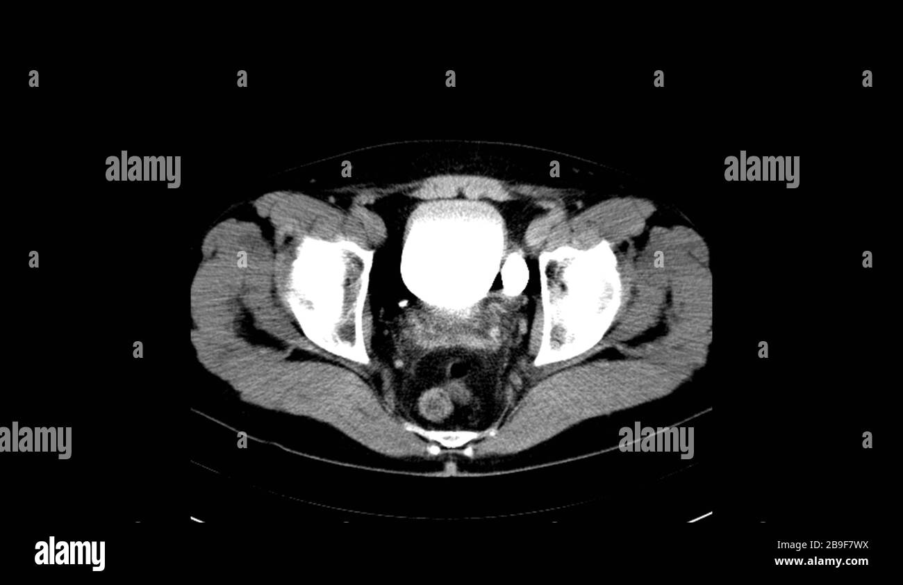Abdomen human, man, CT scan Stock Photo - Alamy