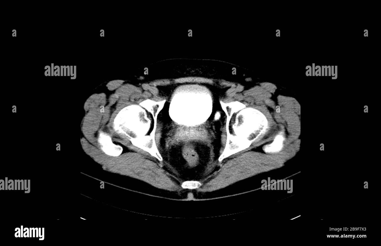 Abdomen human, man, CT scan Stock Photo - Alamy