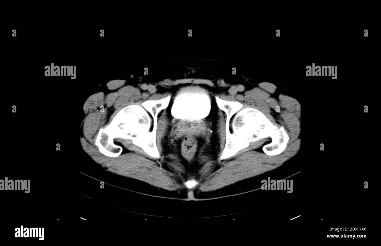 Abdomen human, man, CT scan Stock Photo - Alamy