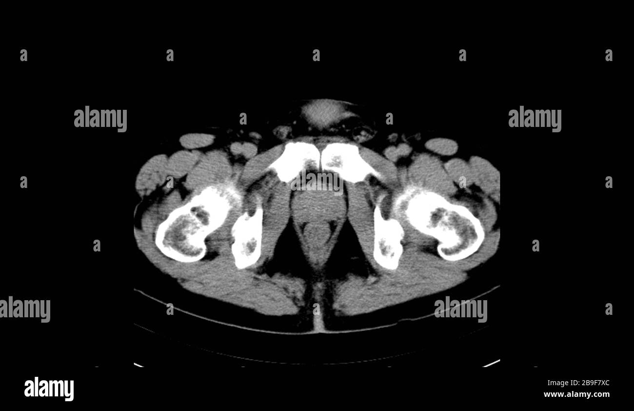 Abdomen human, man, CT scan Stock Photo - Alamy