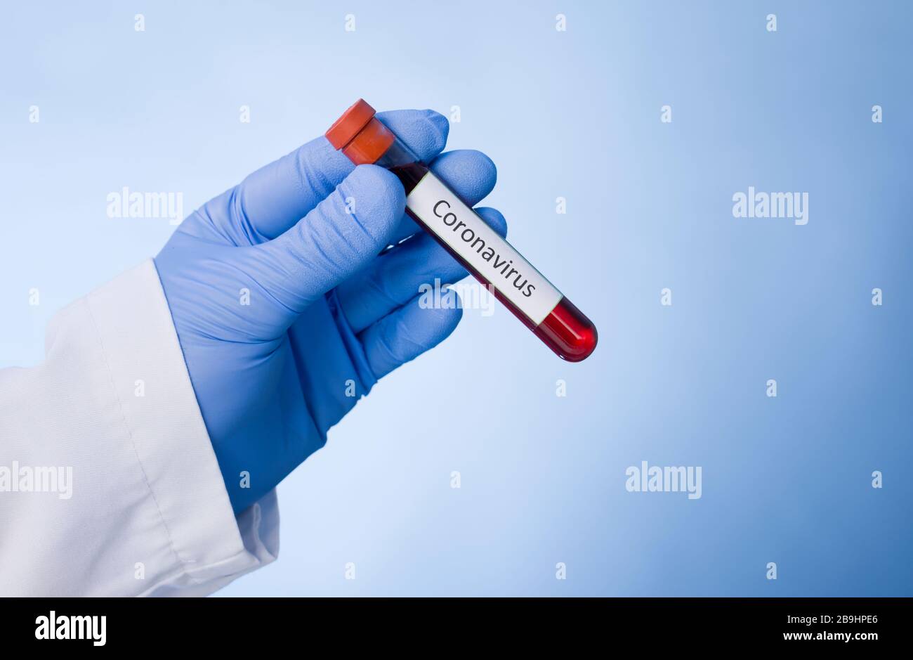Coronavirus blood test result, blood infected with coronavirus in ...