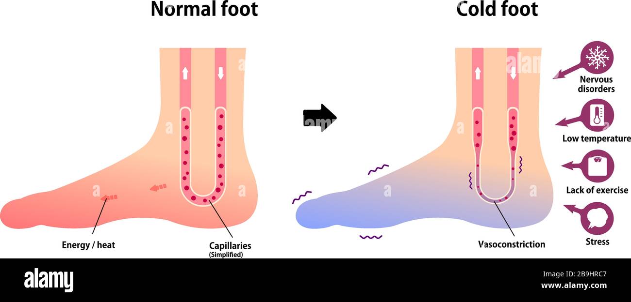 Comparison illustration of normal foot and cold foot ( sensitivity to ...