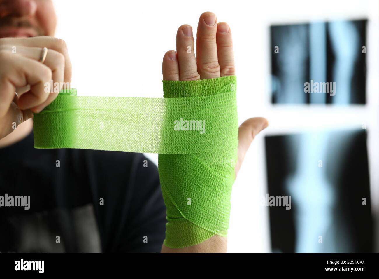 X ray hand man fracture first hi-res stock photography and images - Alamy