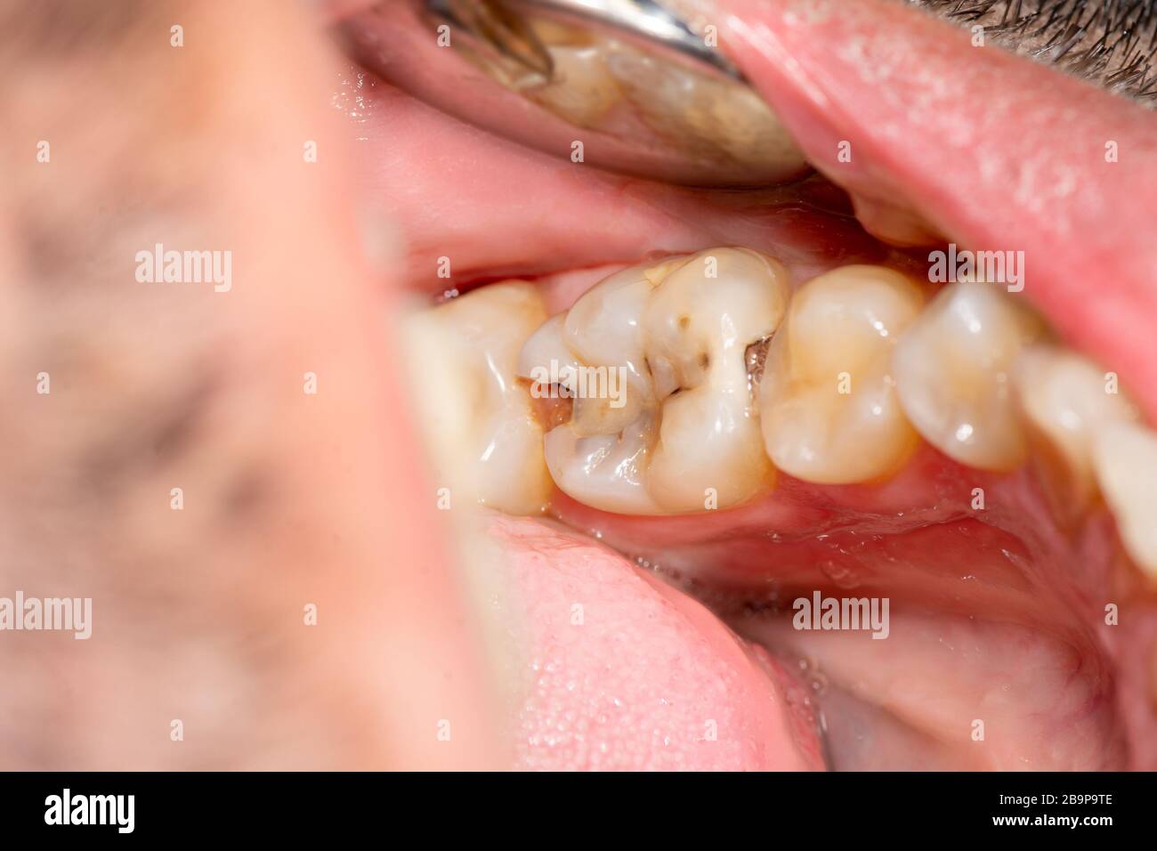 treatment tooth decay with subsequent filling with photopolymer ...