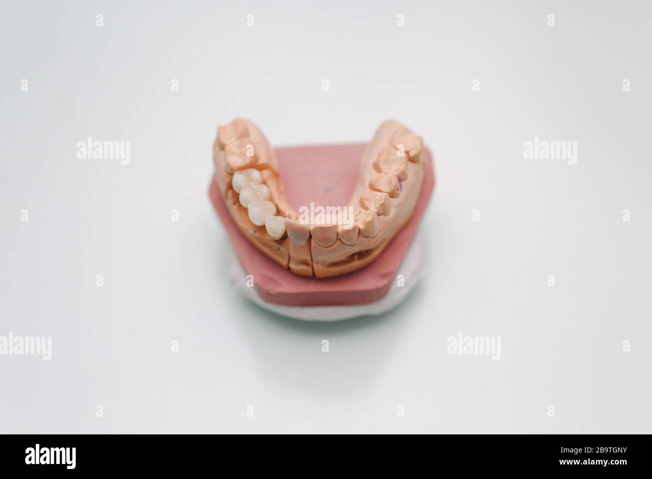 Dental layout of the human jaw with teeth and implants Stock Photo - Alamy