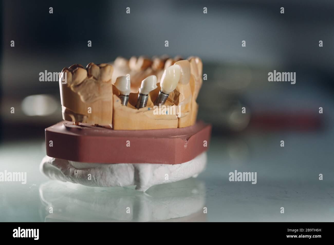 Dental layout of the human jaw with teeth and implants Stock Photo - Alamy