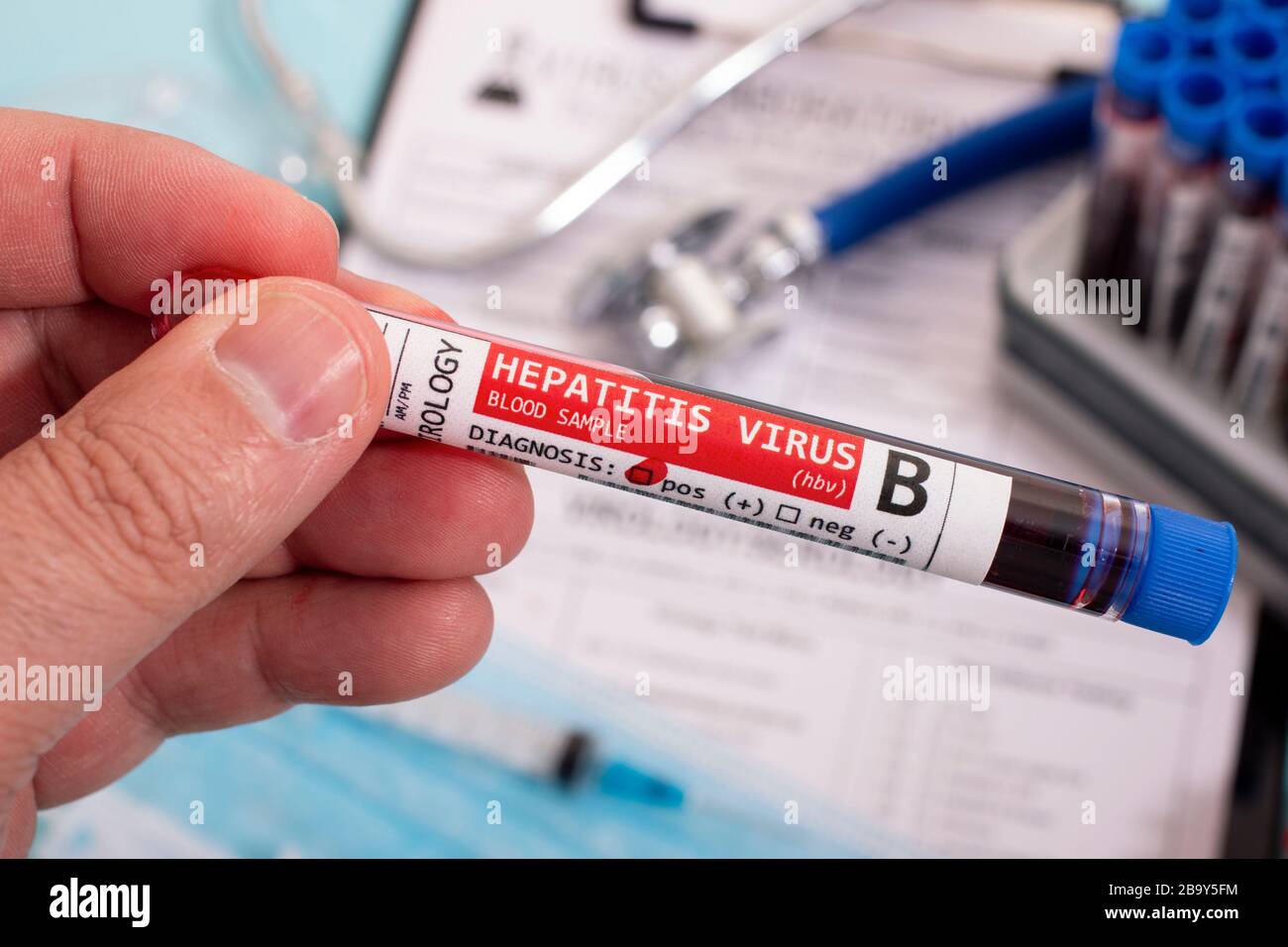 Fictional Blood samples with infected Hepatitis B virus, with ...