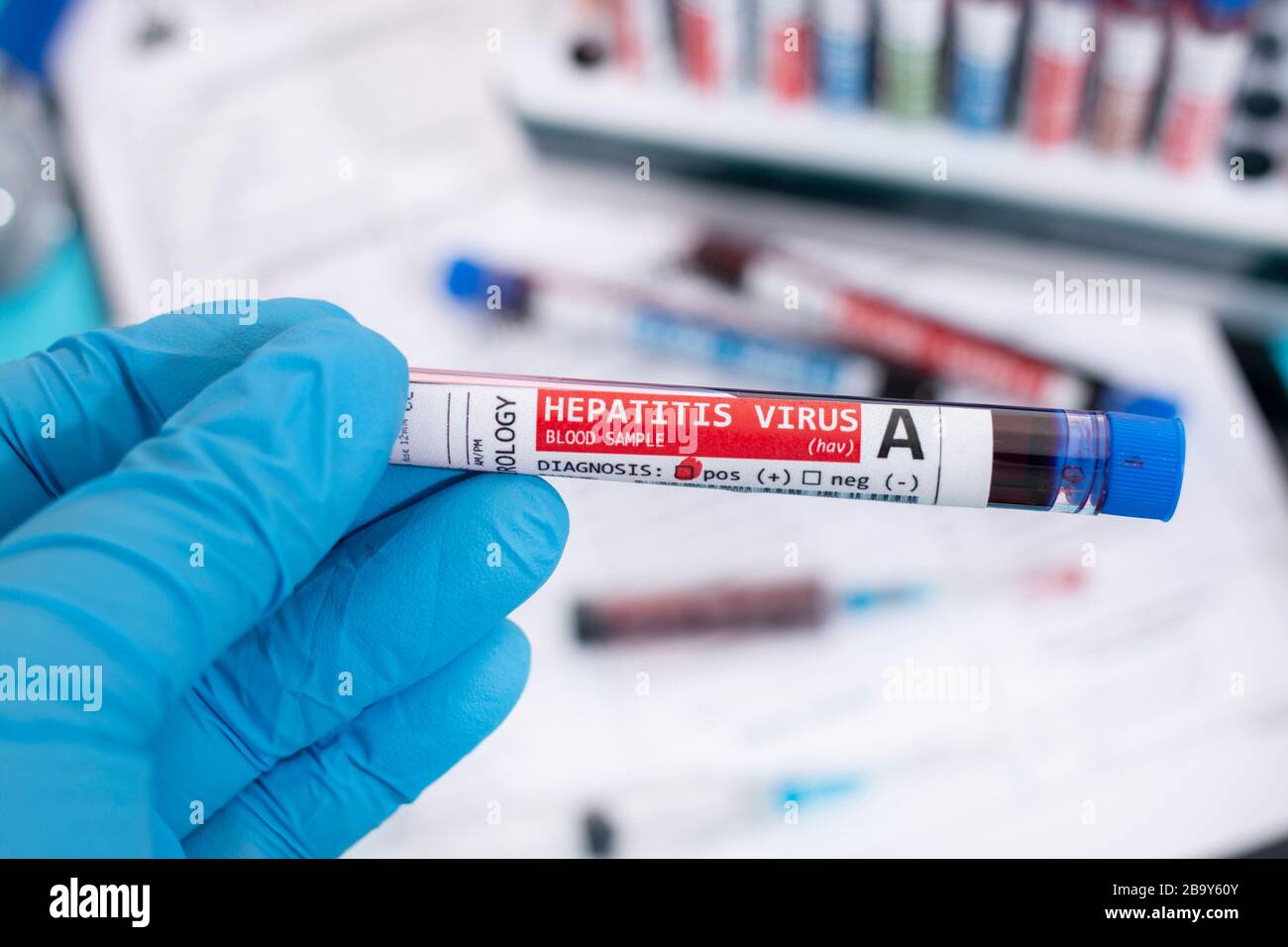 Fictional Blood samples with infected hepatitis A virus, with ...
