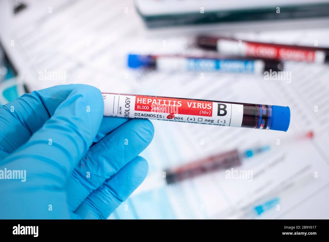 Fictional Blood samples with infected hepatitis B virus, with ...
