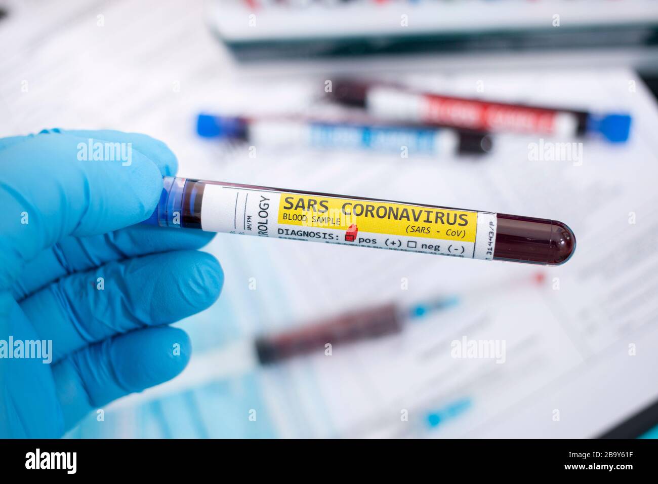 Fictional Blood samples with infected SARS coronavirus, with ...
