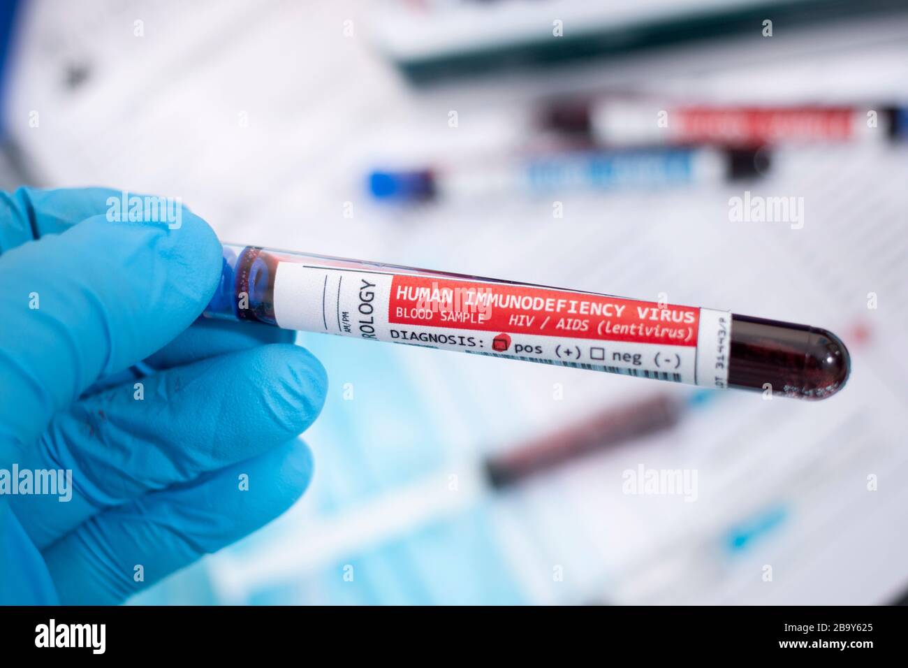 Fictional Blood samples with infected HIV/AIDS virus, with stethoscope ...