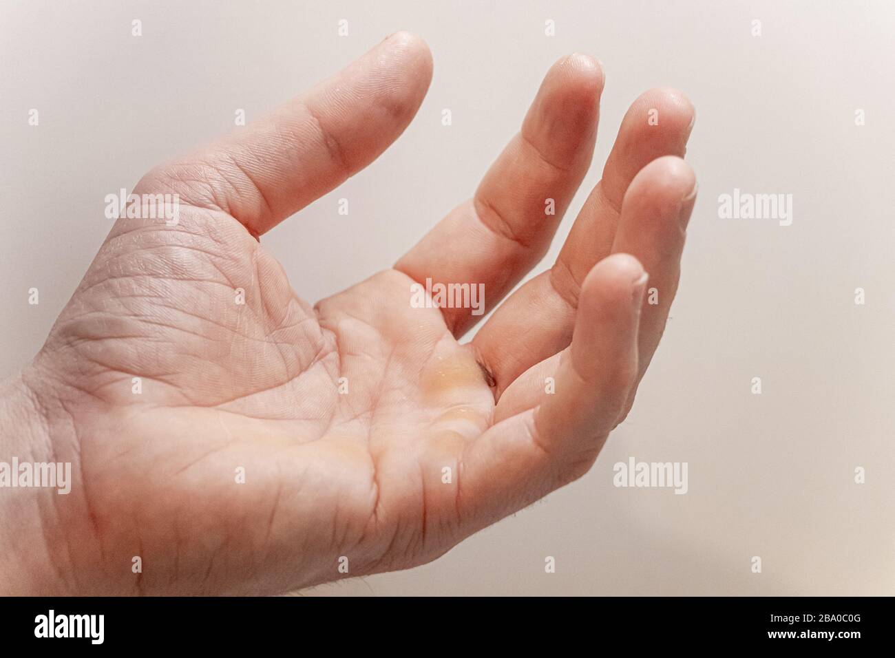 Callus finger hi-res stock photography and images - Alamy