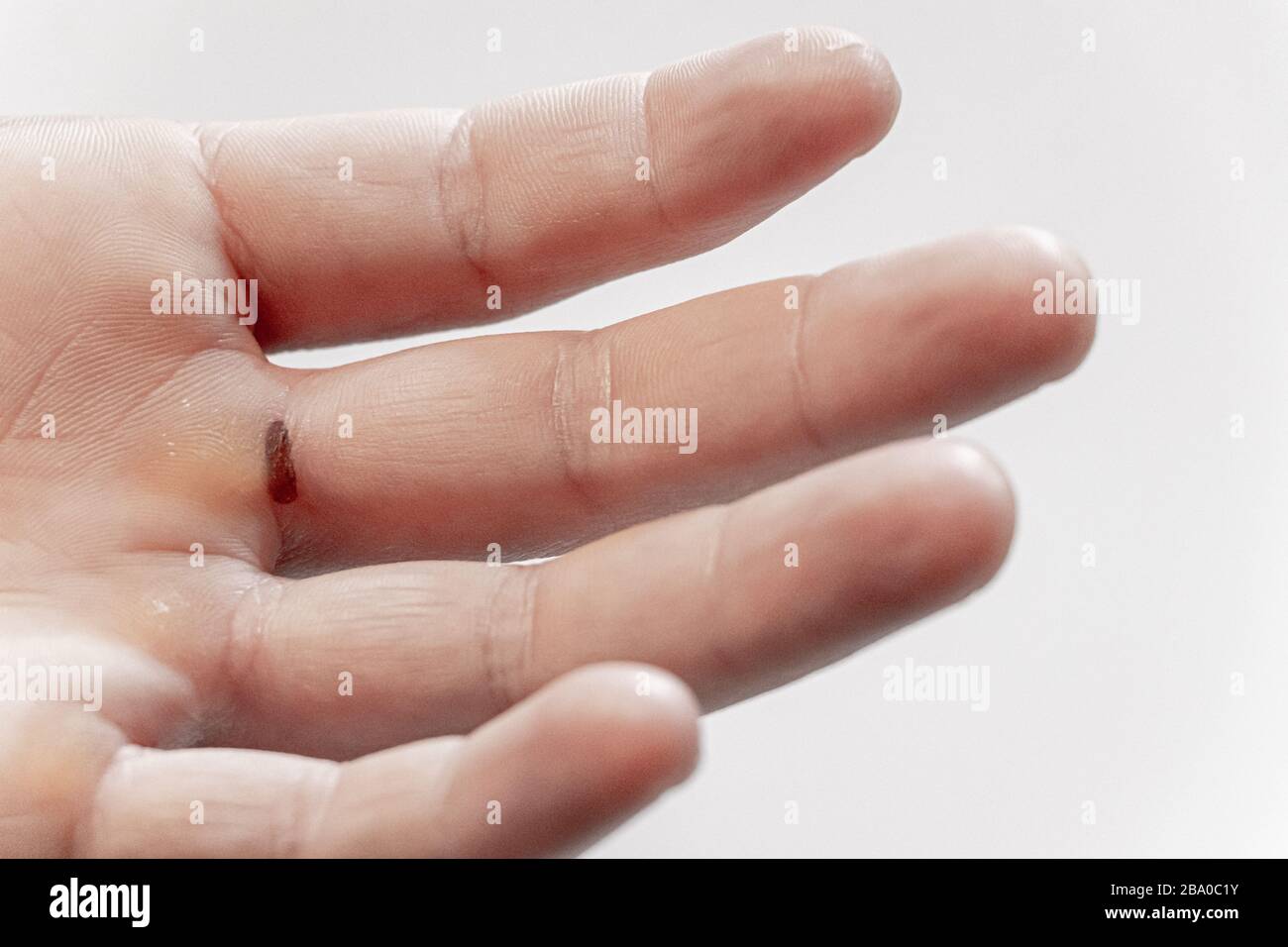 Callus finger hi-res stock photography and images - Alamy