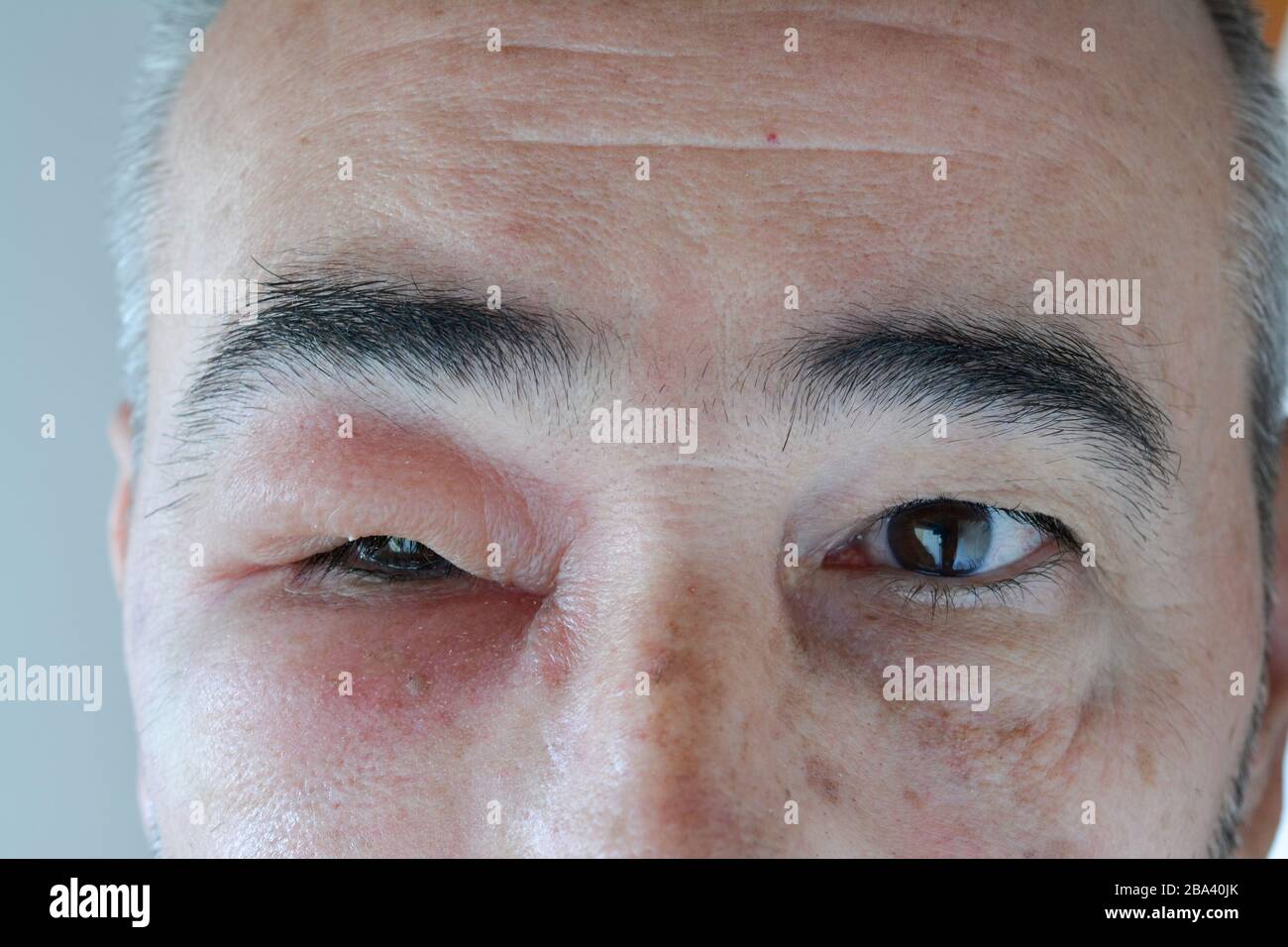Bee Sting Swelling Face