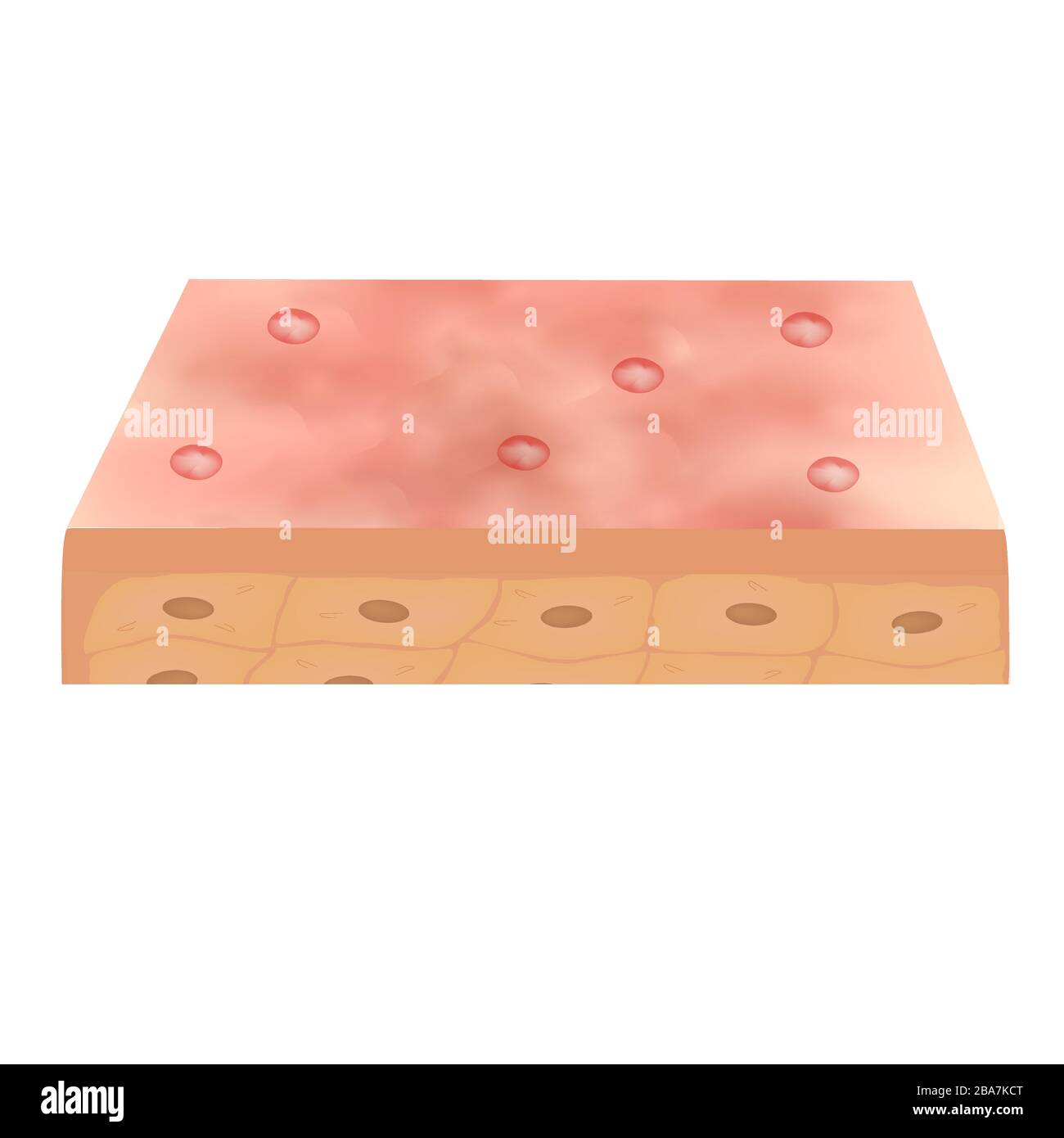 Closed comedones. Acne on the skin. Dermatological and cosmetic ...