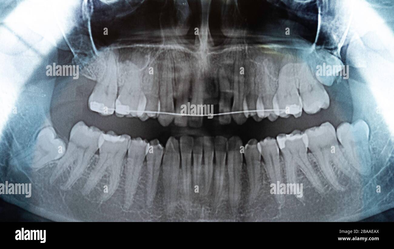 Original black and white x-ray teeth scan. Upper teeth with dental ...