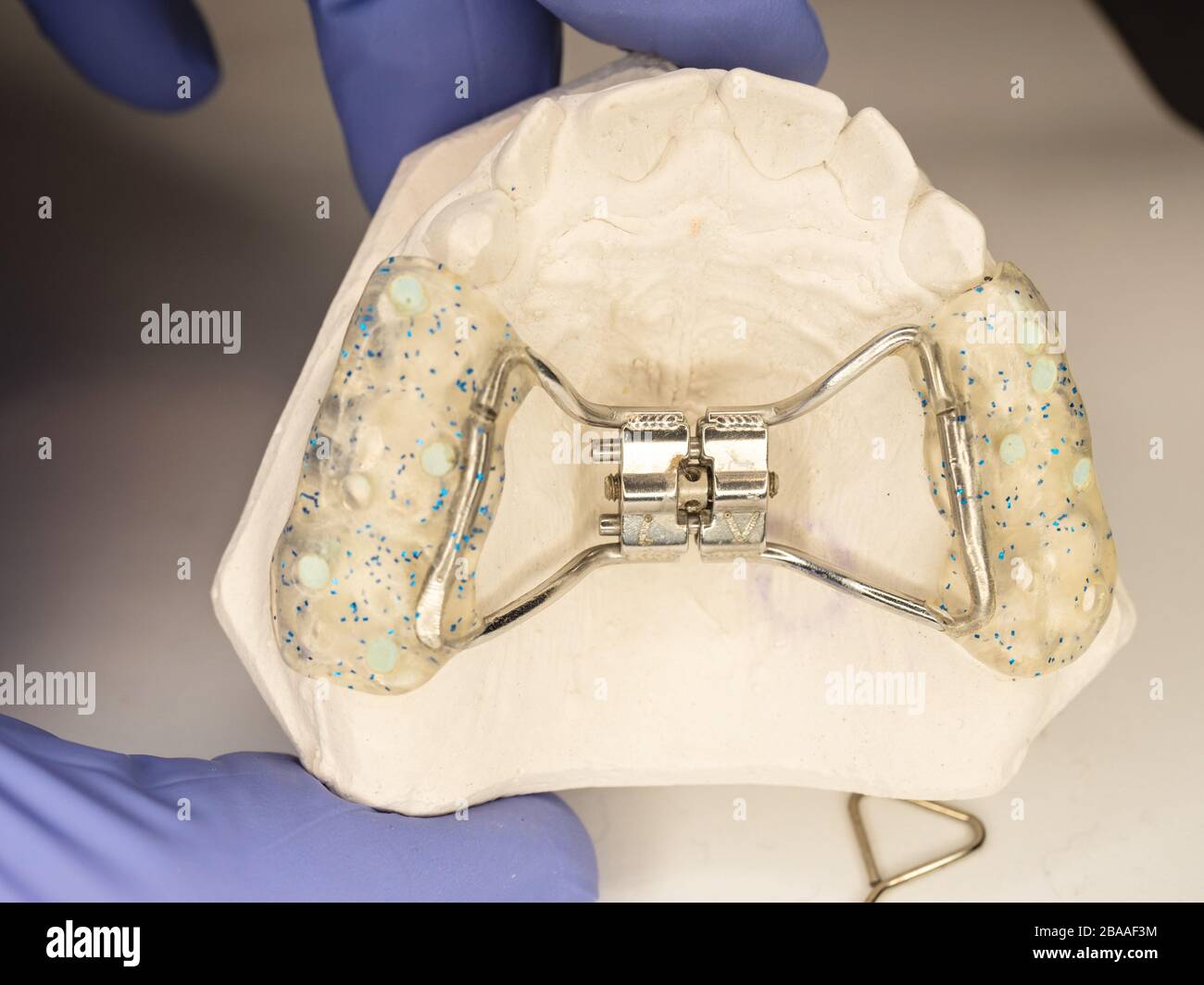 Hyrax braces wear on patient teeth gypsum model. Dentist check exact ...