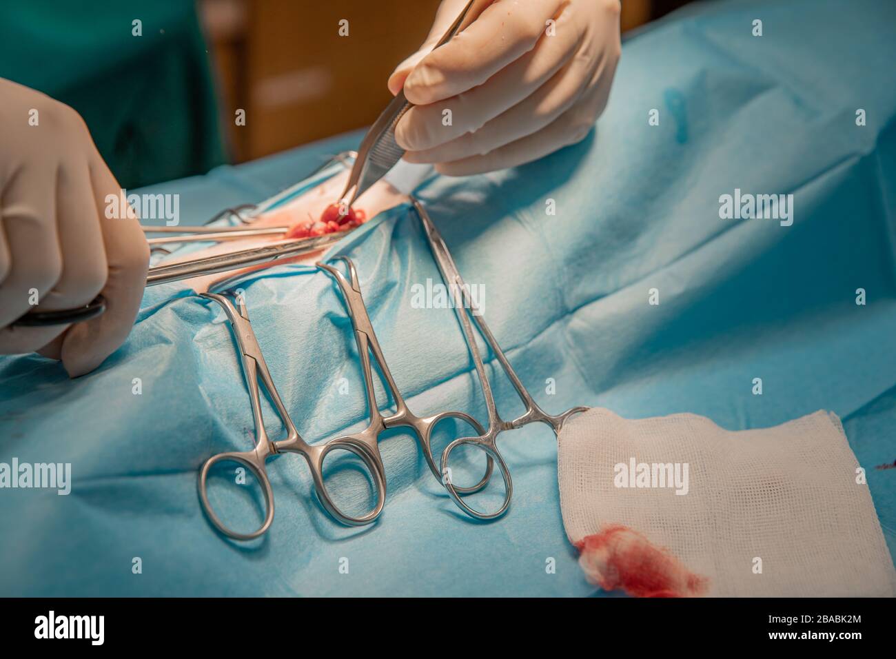 Ovary removal hi-res stock photography and images - Alamy