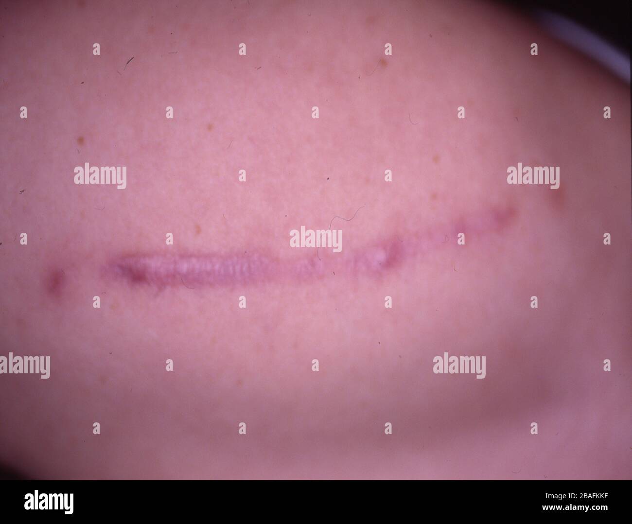 scar on skin Stock Photo - Alamy
