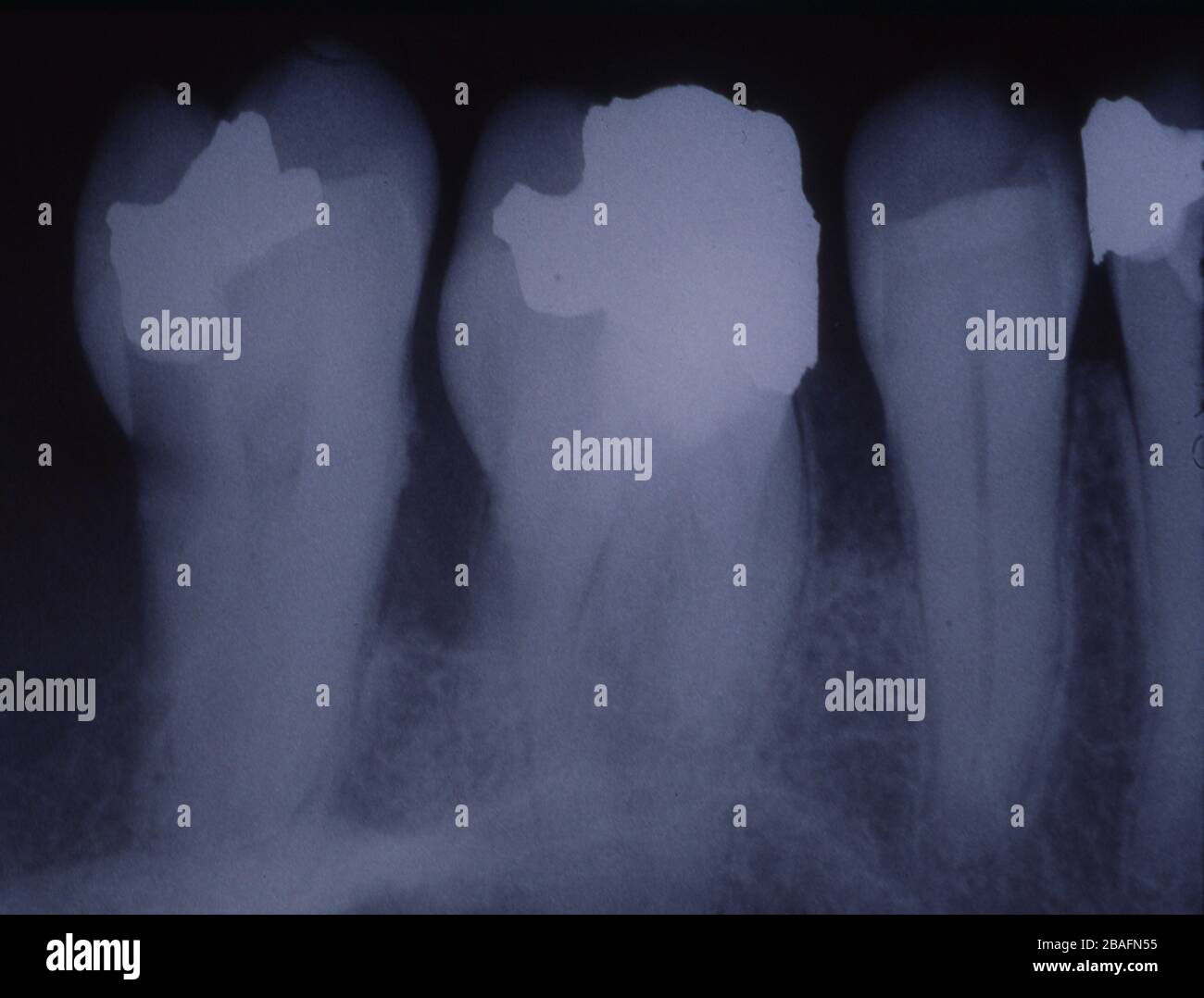 X-ray image of teeth with fillings and bridges Stock Photo - Alamy
