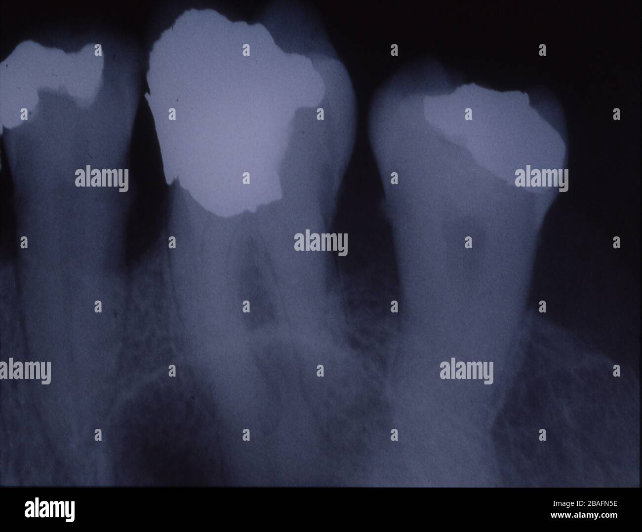 X-ray image of teeth with fillings and bridges Stock Photo - Alamy