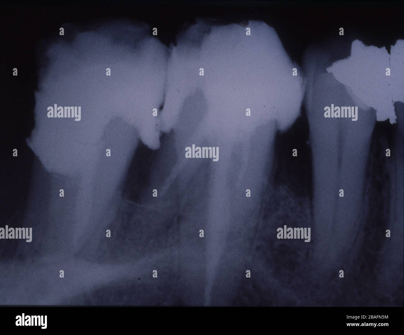 X-ray image of teeth with fillings and bridges Stock Photo - Alamy
