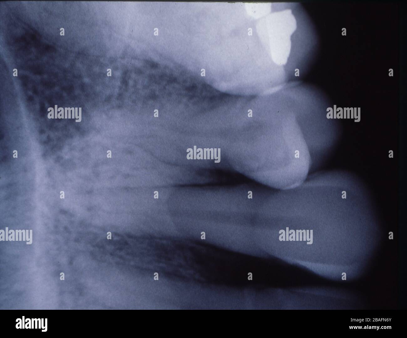 X-ray image of teeth with fillings and bridges Stock Photo - Alamy
