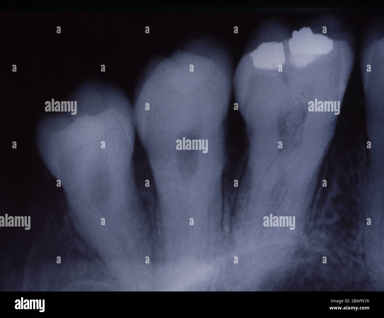 X-ray image of teeth with fillings and bridges Stock Photo - Alamy