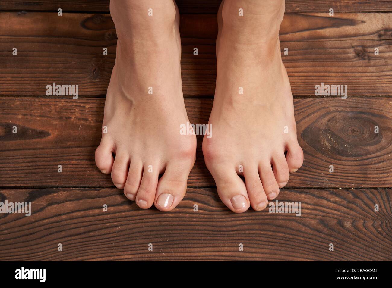 Hllux Valgus on female legs close up on wooden background. Foot joint ...