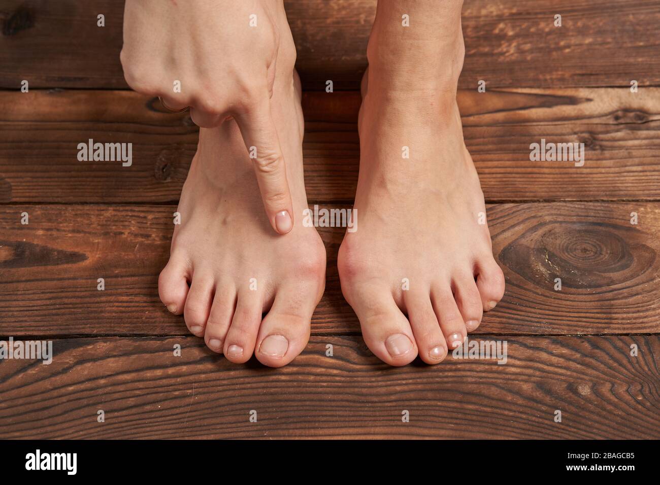 Hllux Valgus on female legs close up on wooden background. Foot joint ...
