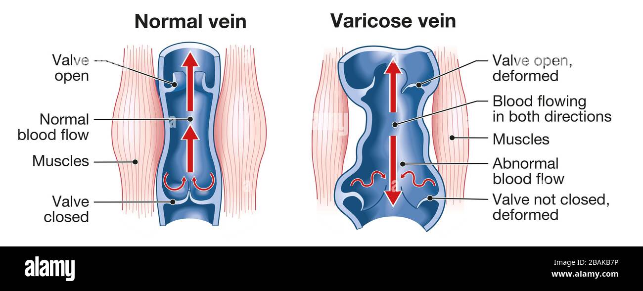 Varicosities Diagram
