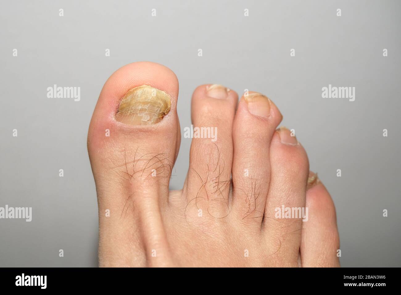 Infected toe nail hi-res stock photography and images - Alamy