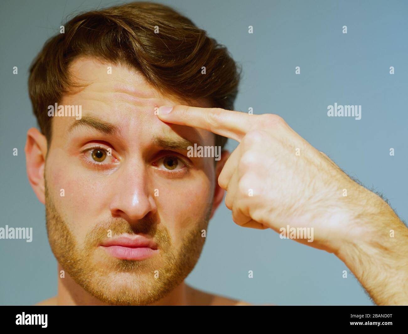 Pimples hi-res stock photography and images - Alamy