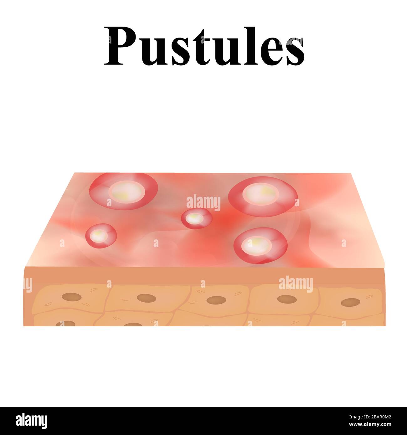 Pustules. Acne on the skin. Dermatological and cosmetic diseases on the ...