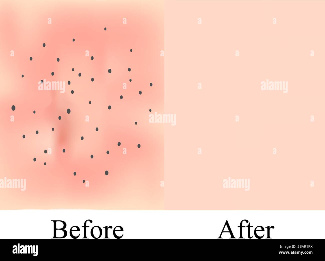 Skin texture with black dots of acne. Before After acne. Skin ...